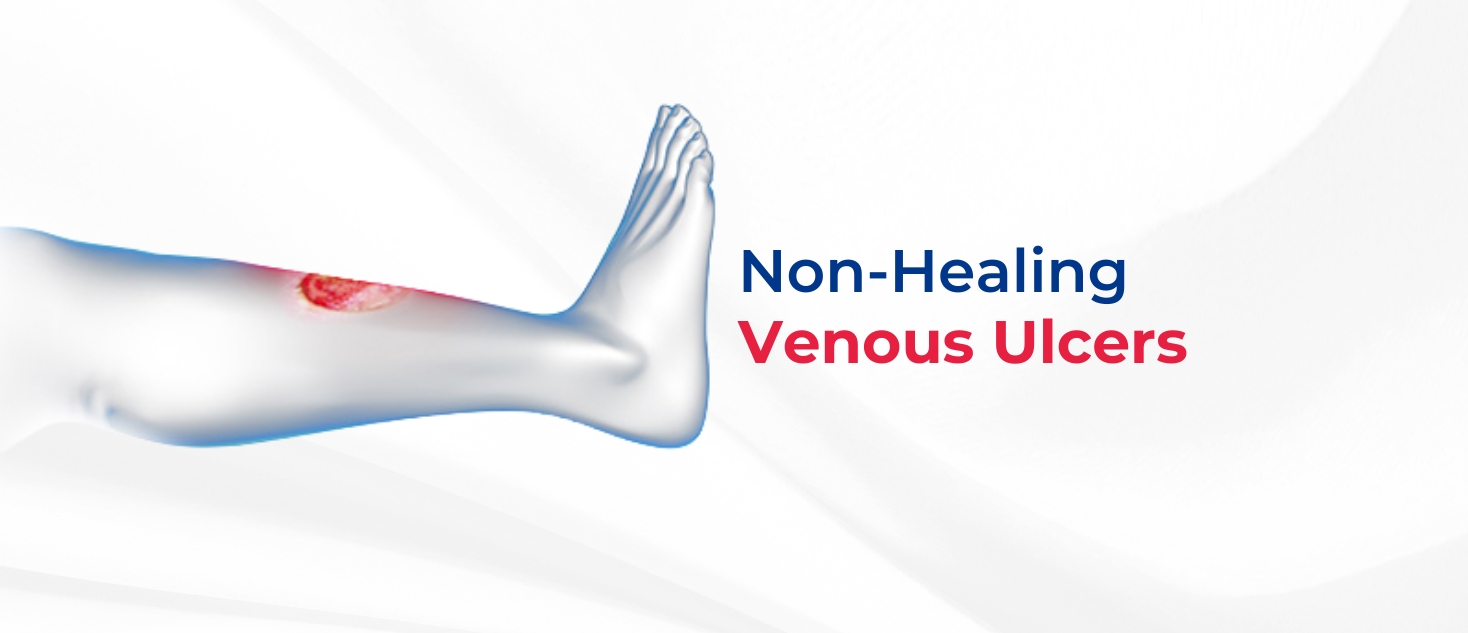 Non Healing Venous Ulcers | United Hospital